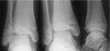 발목 골절fracture Of Ankle 발목이 비틀리면서 발목 뼈가 부러졌어요 네이버 블로그